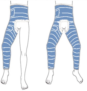 Different Types of Fracture Casting | Guide to Orthopedic Casts for Limbs