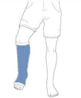 Different Types of Fracture Casting | Guide to Orthopedic Casts for Limbs